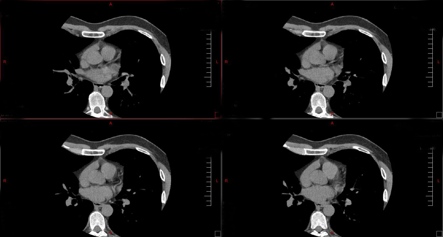 Score calcique coronaire - Doctinet - Plateforme de téléconsultation